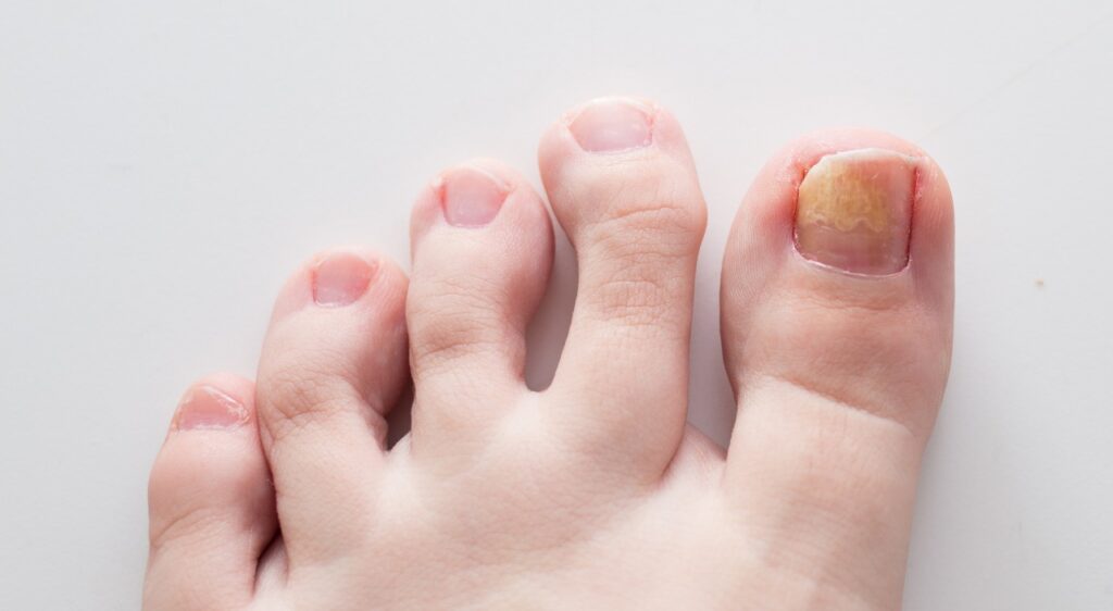 Nail Fungus Removal in Pembroke Pines, Margate, Kendall